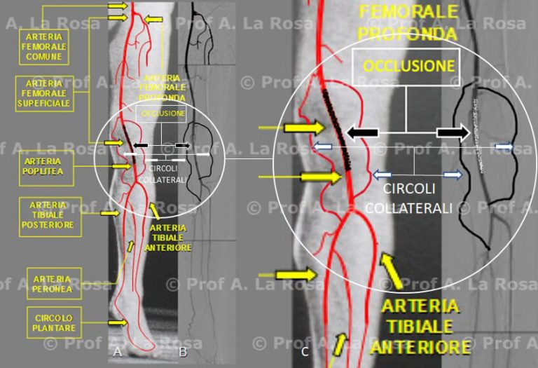 Ischemia Critica degli Arti Inferiori | Diagnosi e cura | Prof. A. La Rosa